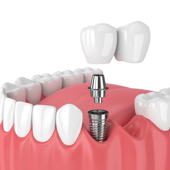 Assessing Bali Dental Implant Treatments In Indonesia