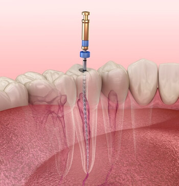 Root Canal Before and After: What to Expect Clearly